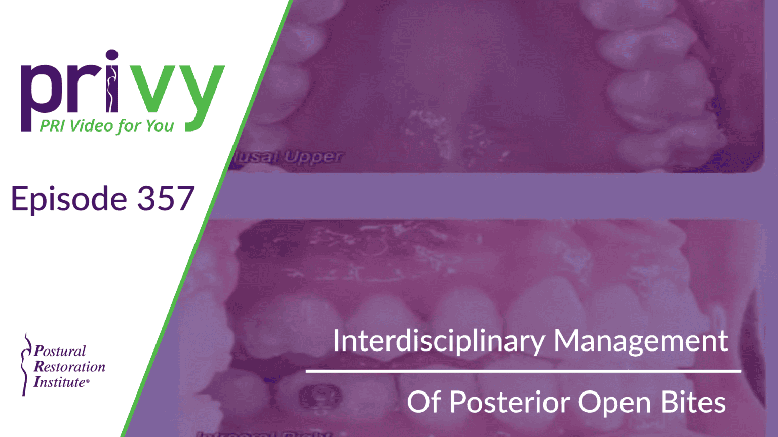 Ep. 357 - Interdisciplinary Management of Posterior Open Bites ...