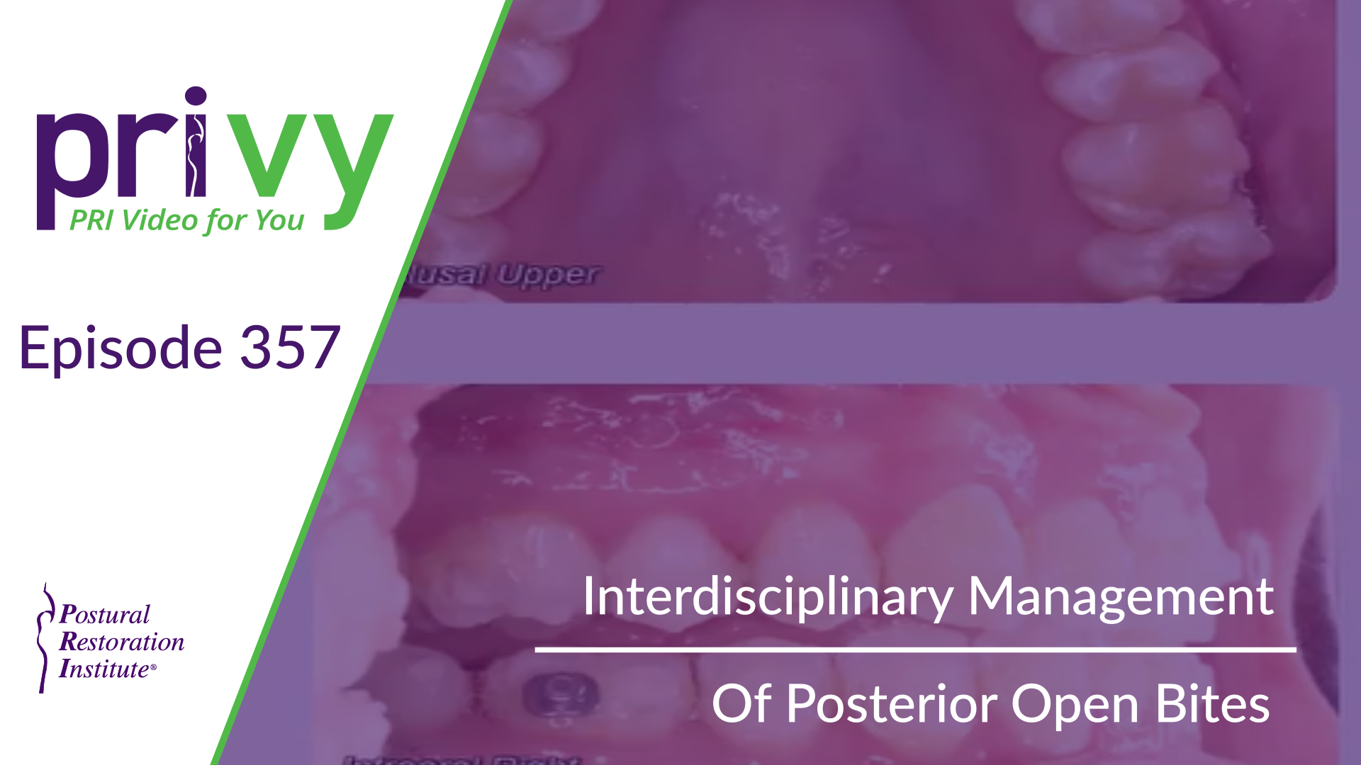 Ep. 357 - Interdisciplinary Management of Posterior Open Bites ...